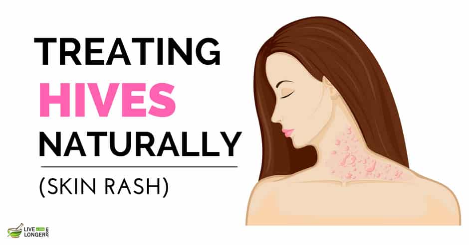 10 Best Home Remedies For Hives That Give Great Relief