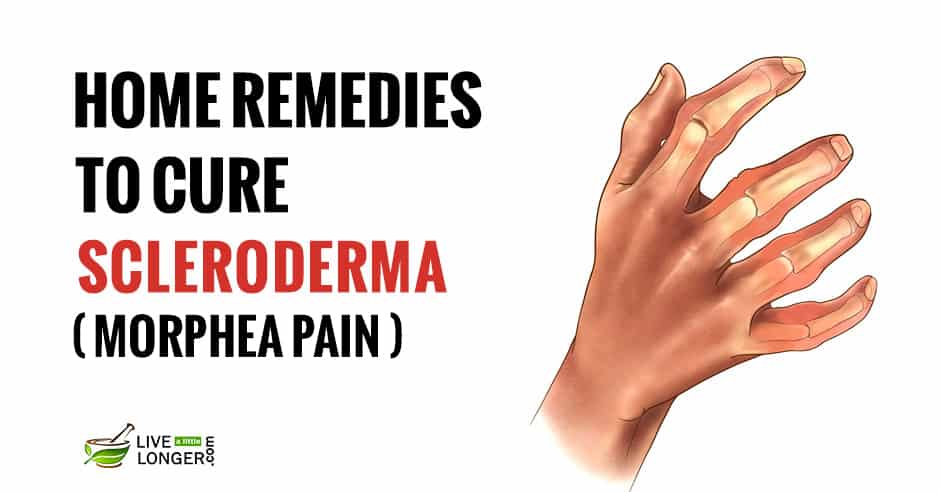 10 Best Home Remedies For Scleroderma